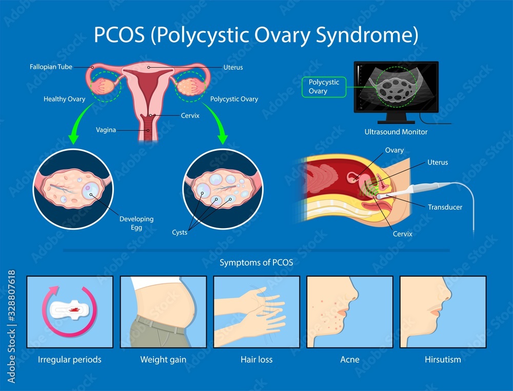 polycystic ovary syndrome PCOS hormonal diagnose diagnostic exam ...