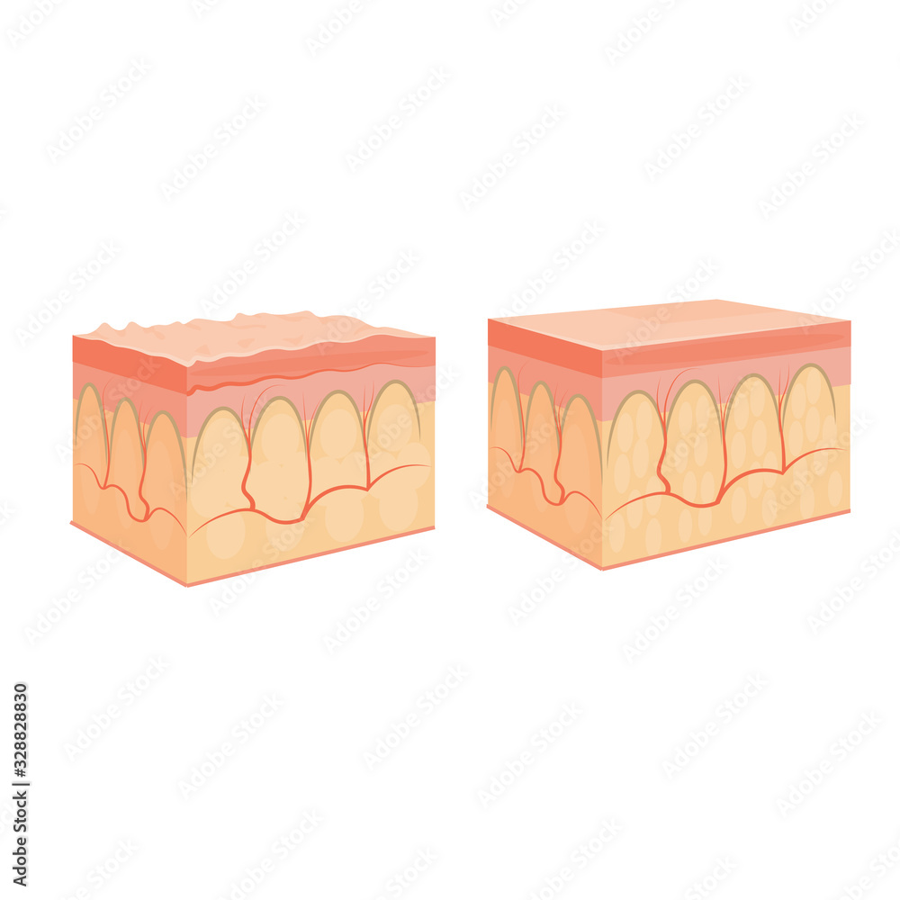 wrinkle and normal skin cross-section of human skin layers structure ...