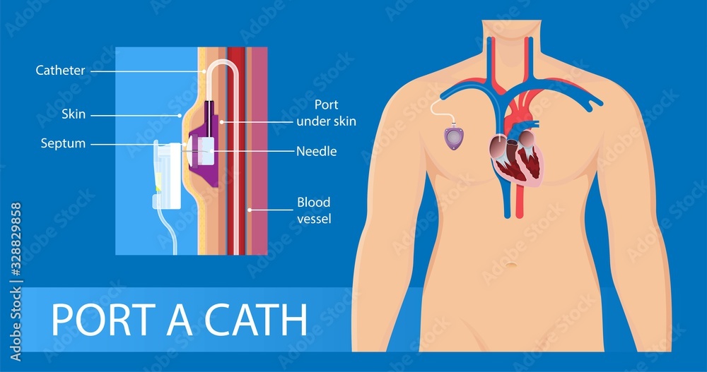 central venous catheter CVC PICC line peripherally inserted access large vein medication fluid ...