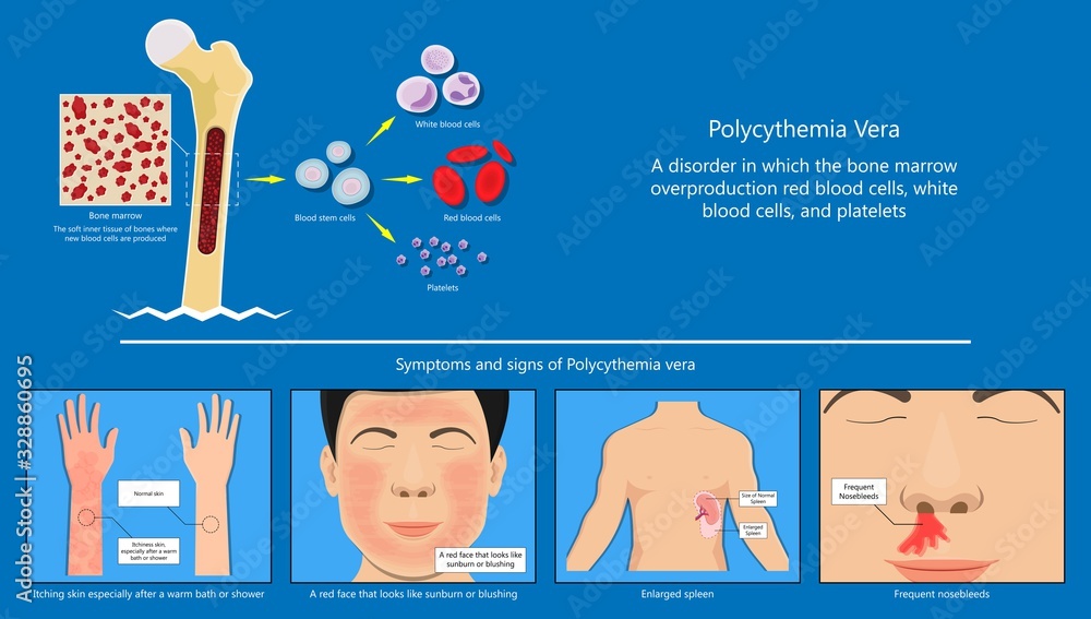 Polycythemia vera PV blood clots cancer bone marrow diagnostic complete ...
