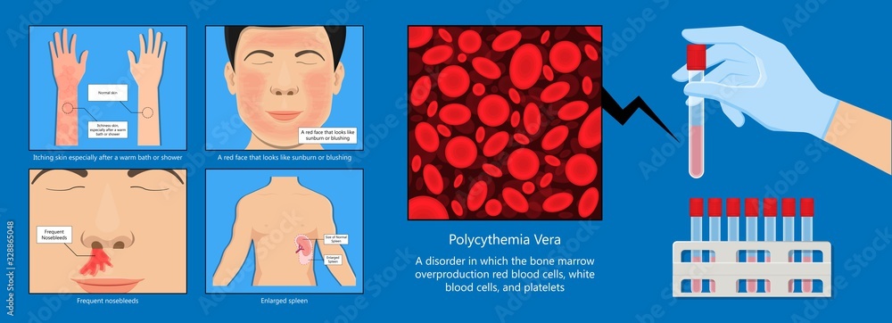Polycythemia vera PV blood clots cancer bone marrow diagnostic complete ...