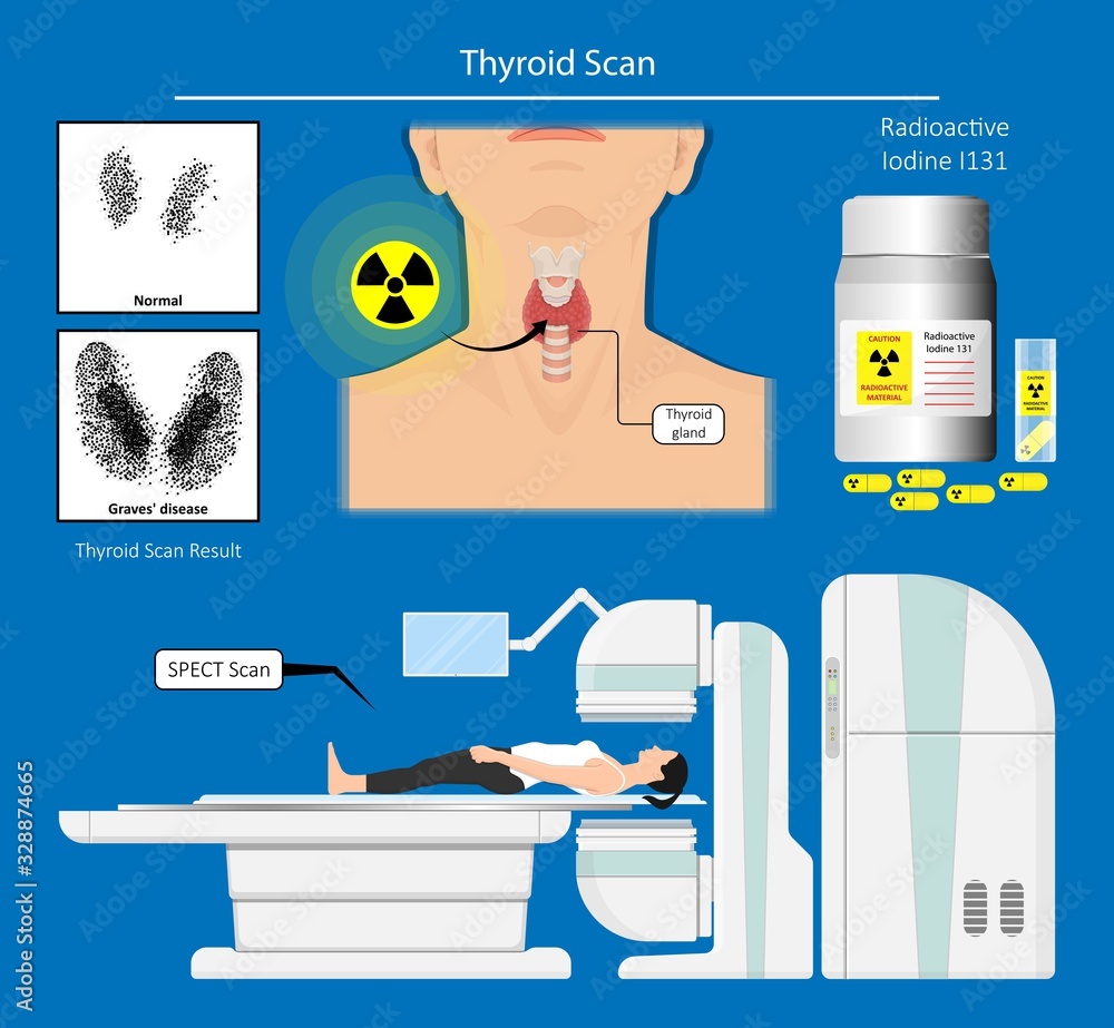 Vetor de Radioactive Iodine Radioiodine I 131 Therapy Treatment Thyroid ... Vetor de Radioactive Iodine Radioiodine I 131 Therapy Treatment Thyroid ...