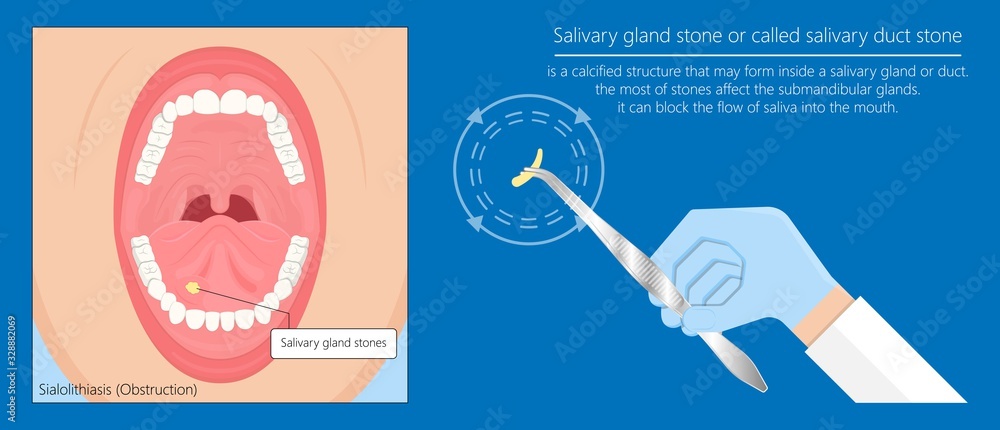Parotid gland Sialadenitis bacterial infection Sialolithiasis blockage ...