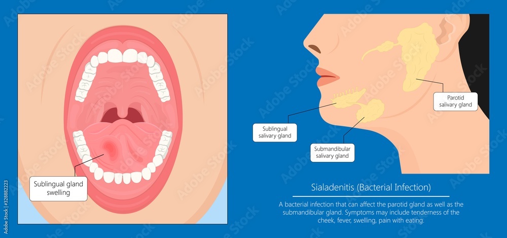 Parotid gland Sialadenitis bacterial infection Sialolithiasis blockage ...