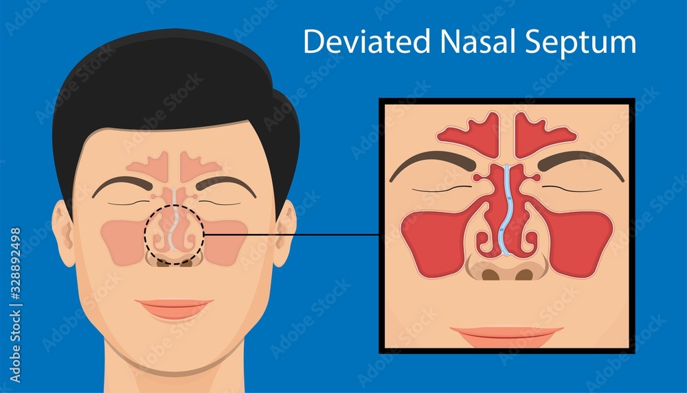 Deviated Septum Diagram