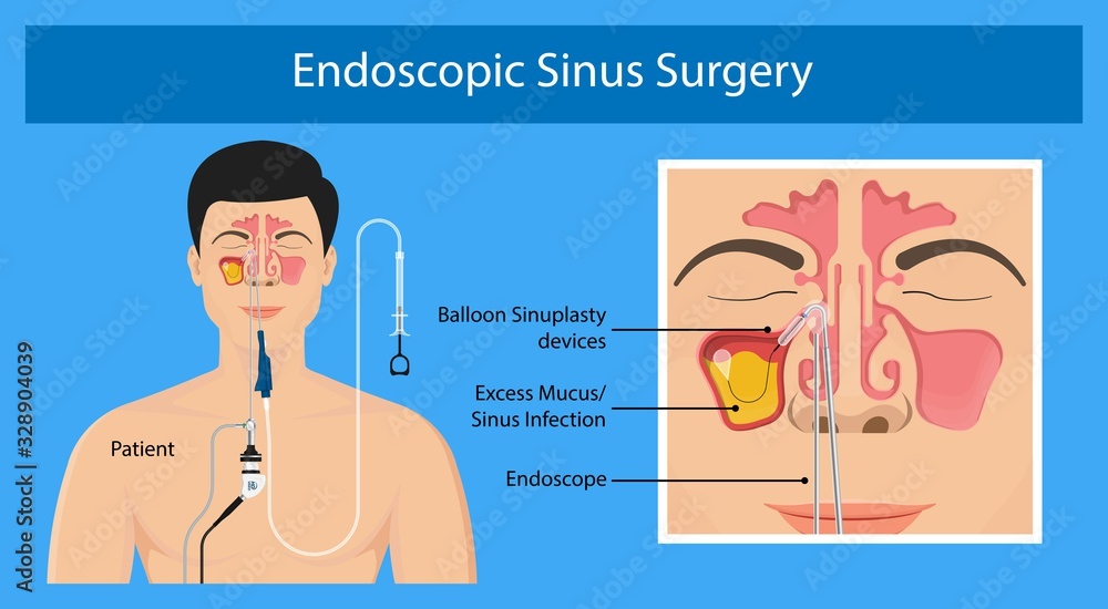 Sinusitis medical disease treat sinuses allergies surgical drug smart ...