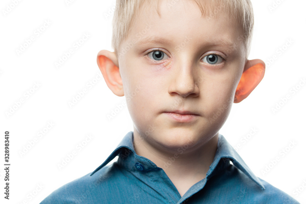 Herpes eye disease on a child face. Stock Photo | Adobe Stock