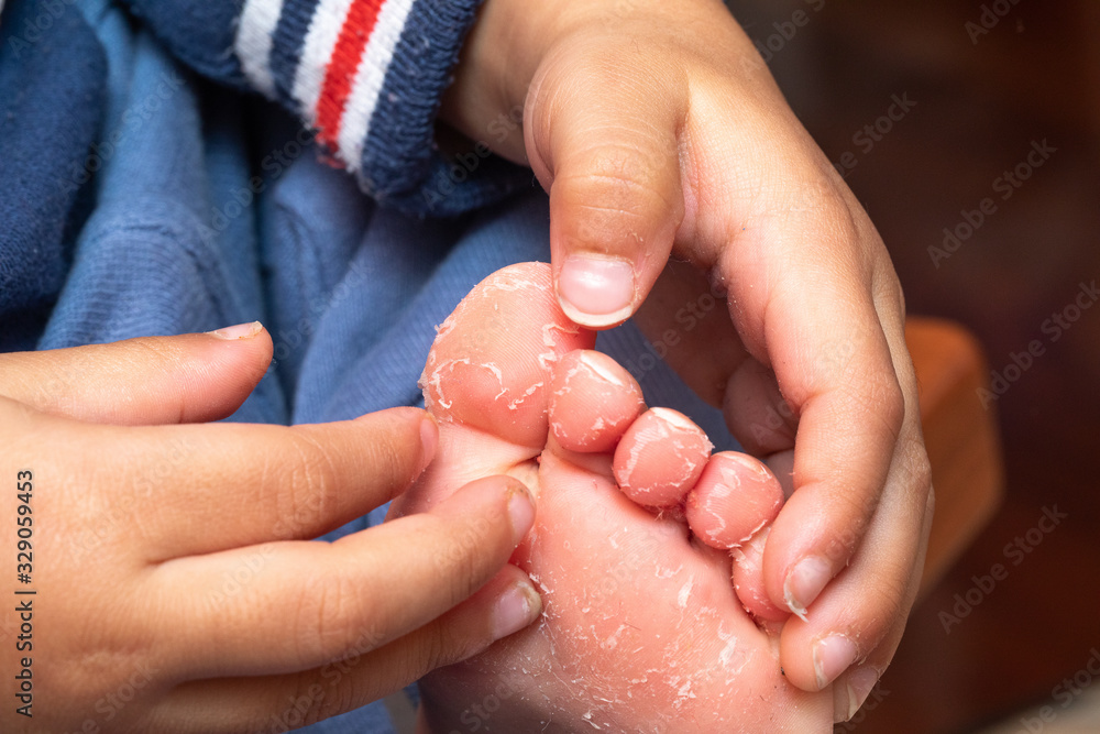 Juvenile plantar dermatosis is a common and chronic dry skin condition ...