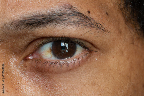 Dark pigment spots on the sclera of a human male eye are usually ...