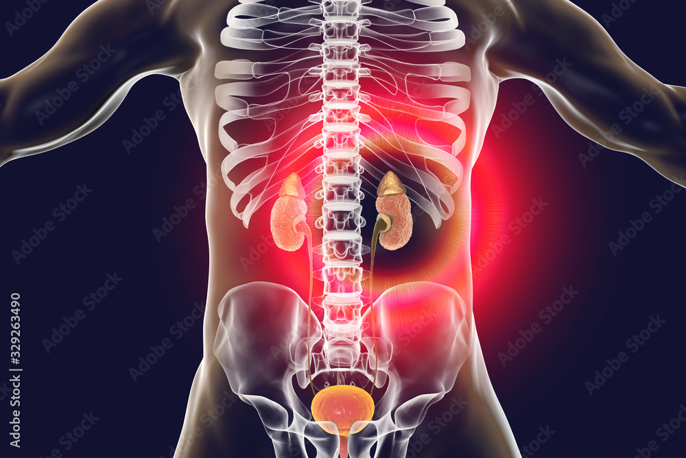Chronic glomerulonephritis, gross pathology, scientifically accurate 3D ...
