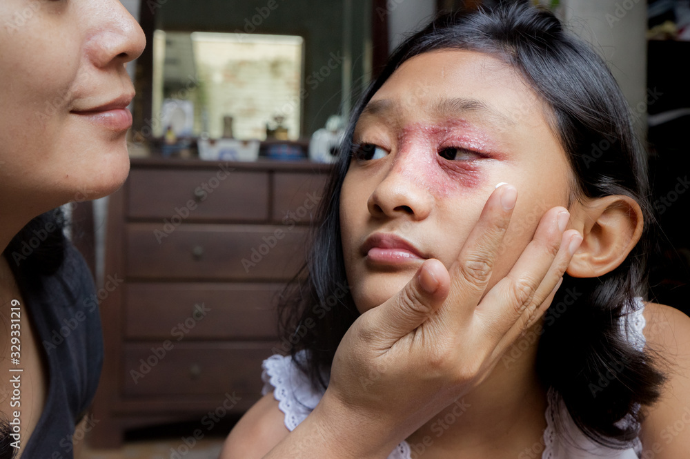 Obraz Southeast Asian Ethnicity Teenage Girl With Circular Shape Skin Obraz Southeast Asian Ethnicity Teenage Girl With Circular Shape Skin