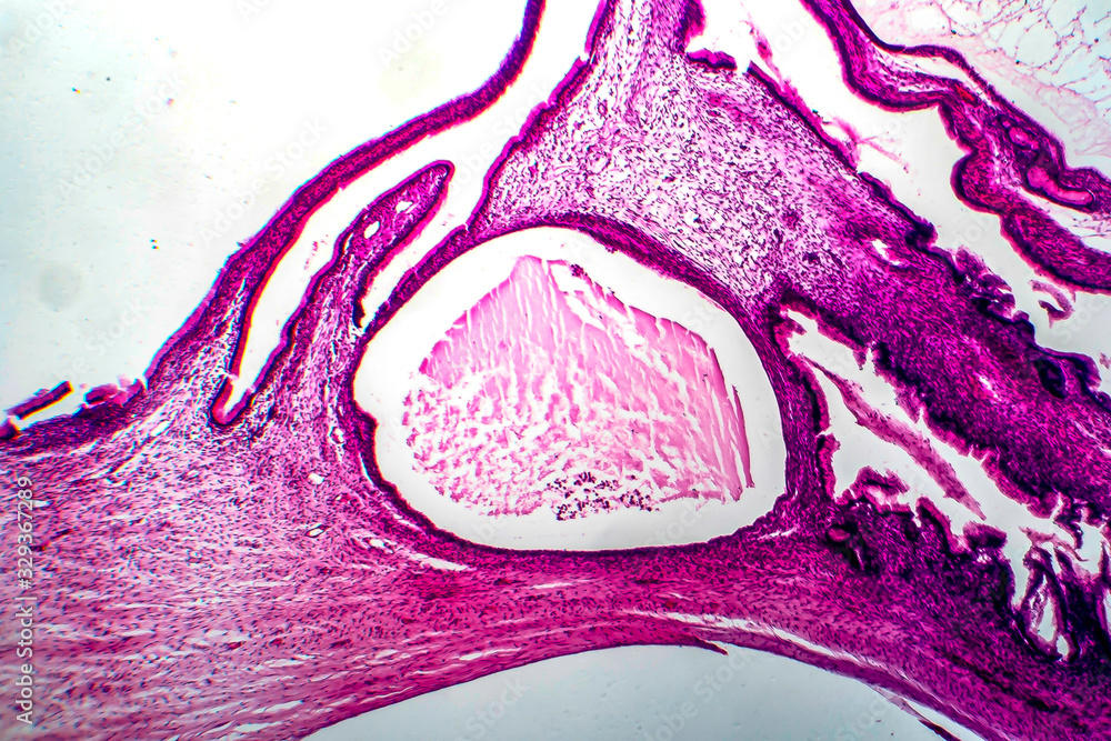 Ovarian mucinous cystadenoma, a benign tumor of ovary, light micrograph ...