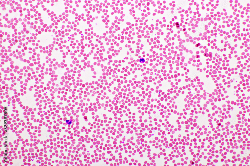 Red blood cells in blood smear, Wright-Giemsa stain, analyze by ...