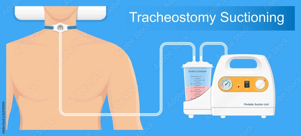Suction adult nares unit lung clear fluid tube nose nasal pump treat ...