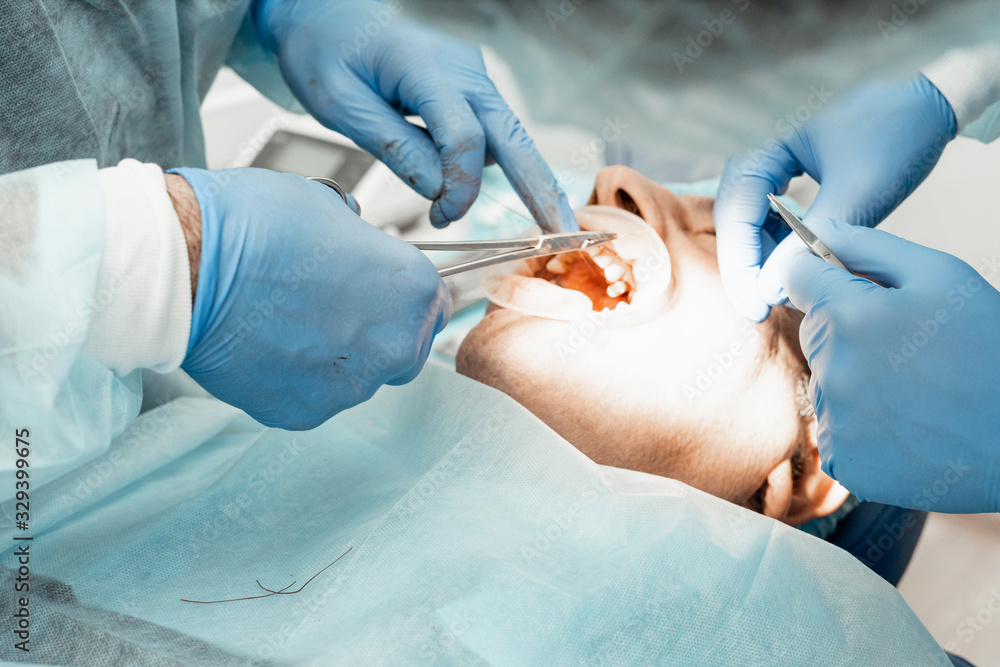 Dentists will perform an operation, implant placement. Real operation ...