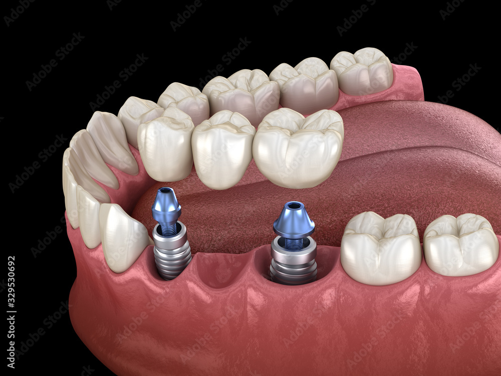 Dental bridge supported by implants. Medically accurate 3D illustration ...