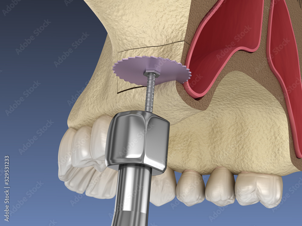 Sinus Lift Surgery - Creating side access to the Sinus. 3D illustration ...