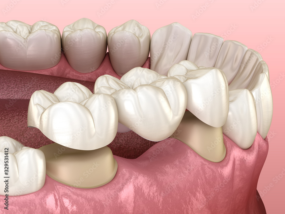 Dental bridge of 3 teeth over molar and premolar. Medically accurate 3D ...