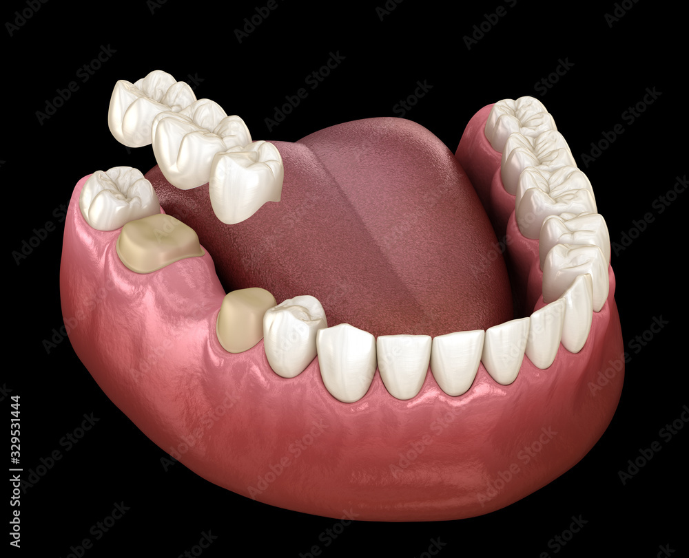 Dental bridge of 3 teeth over molar and premolar. Medically accurate 3D ...