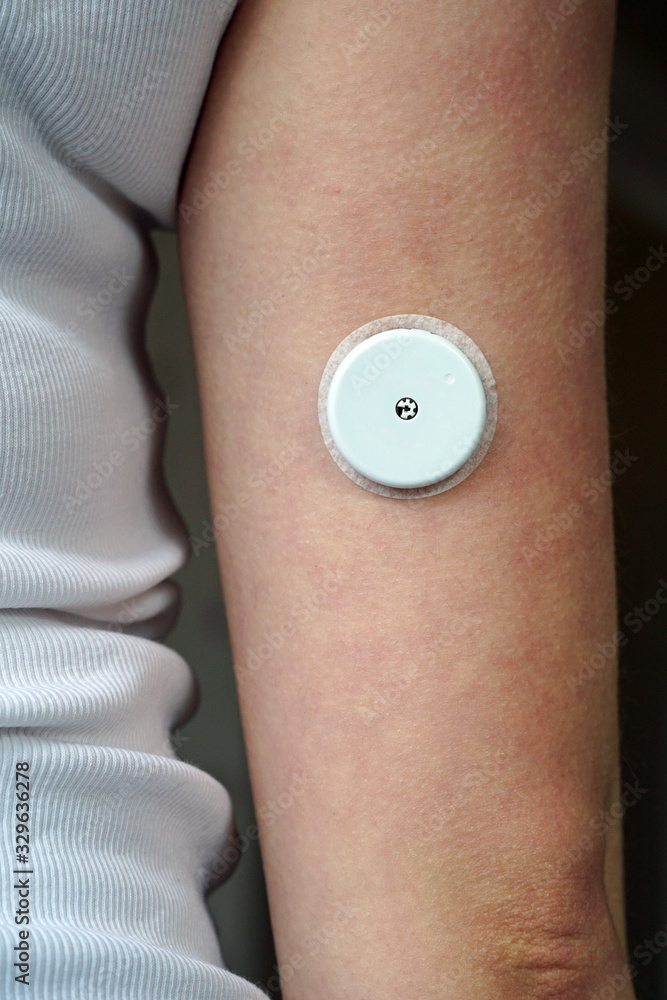 Blood glucose monitoring sensor called FreeStyle Libre attached to an ...