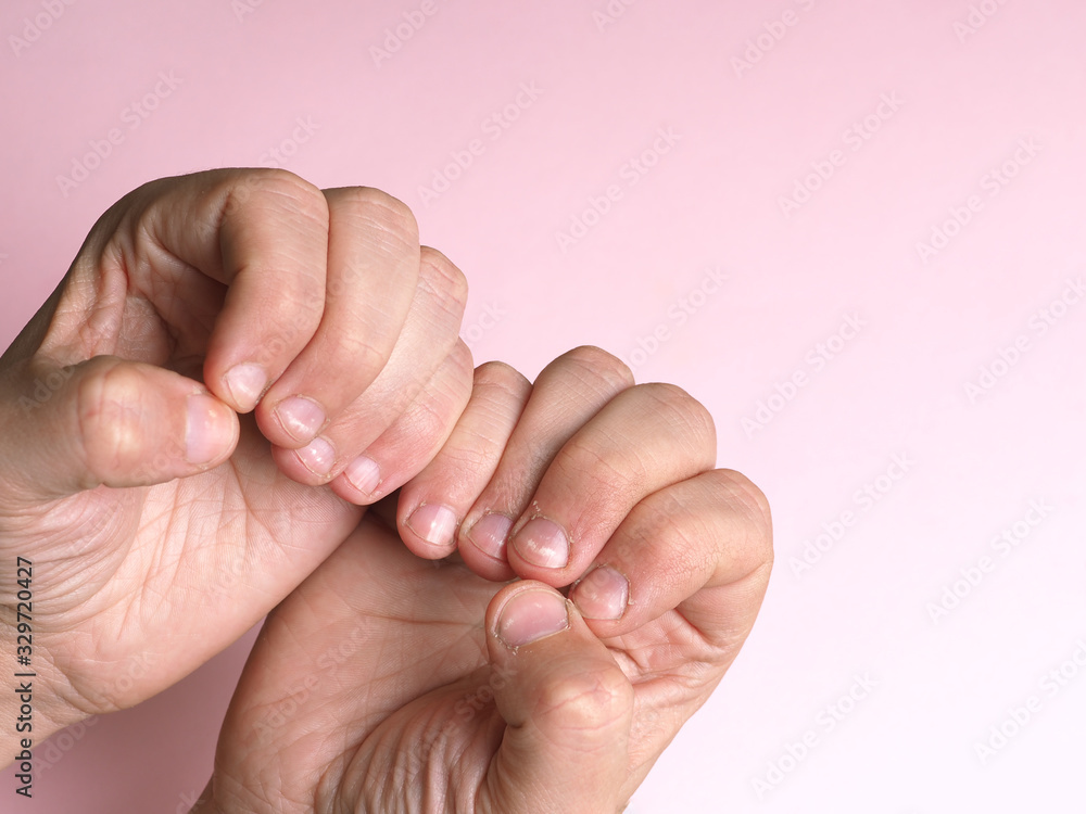 White spots on the nails of the male hand caused by a deficiency of ...