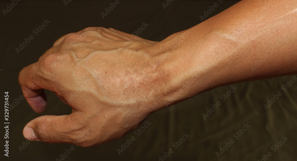 Keloid scar (Hypertrophic Scar) on man hand skin after accident ...