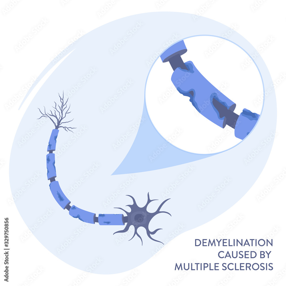 Demyelination of neuron shealth under microscope. Loss of nerve cell ...
