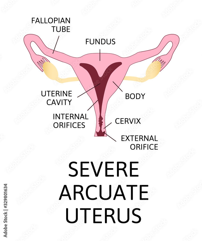 The shape of the uterus, the female reproductive organ. normal, mild ...