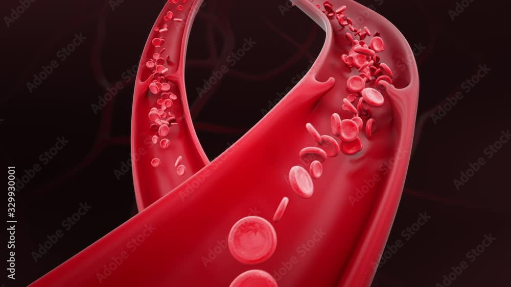 Stockvideo Blood Clot Formed inside a Vein. Red Blood Cells Blocked ...