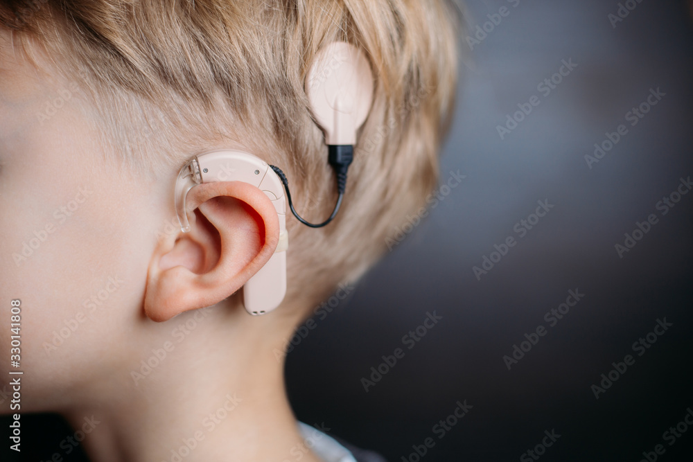 cochlear implant on the boy’s head. hearing aid. copy space Stock Photo ...