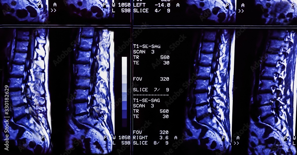 Magnetic resonance imaging of a patient spine with chronic back pain ...