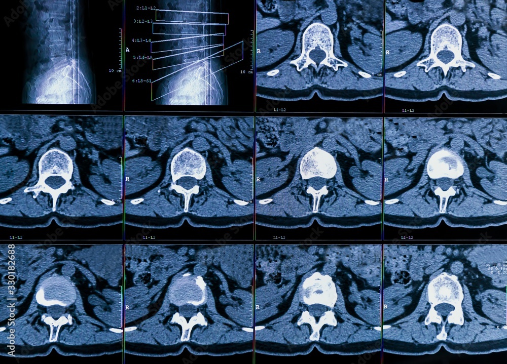 Results of computer tomography or CT imaging of human spine of a ...