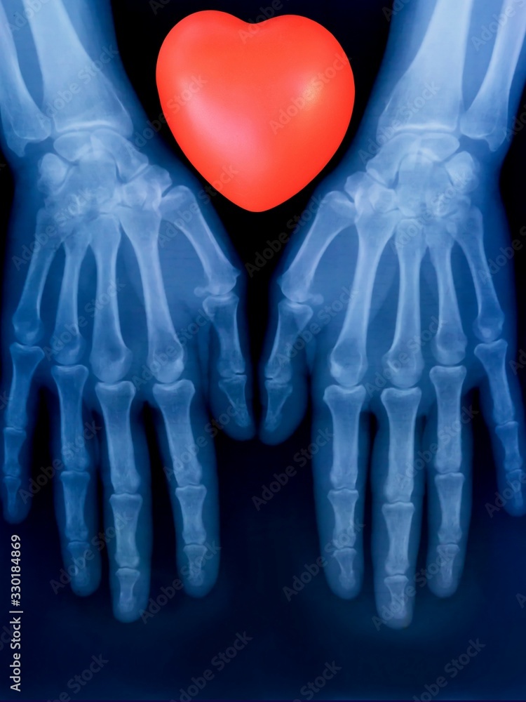 X-ray plate of the bones of the both human hands and red heart sign ...
