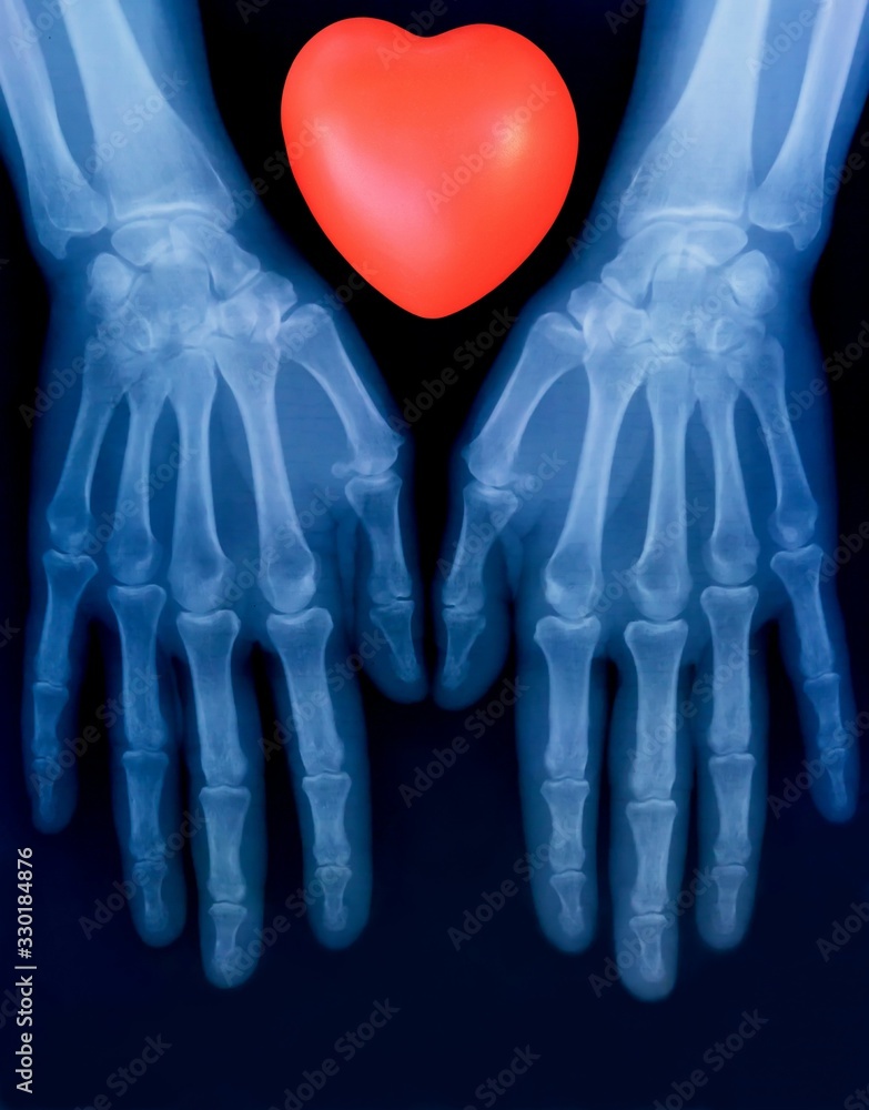 X-ray plate of the bones of the both human hands and red heart sign ...