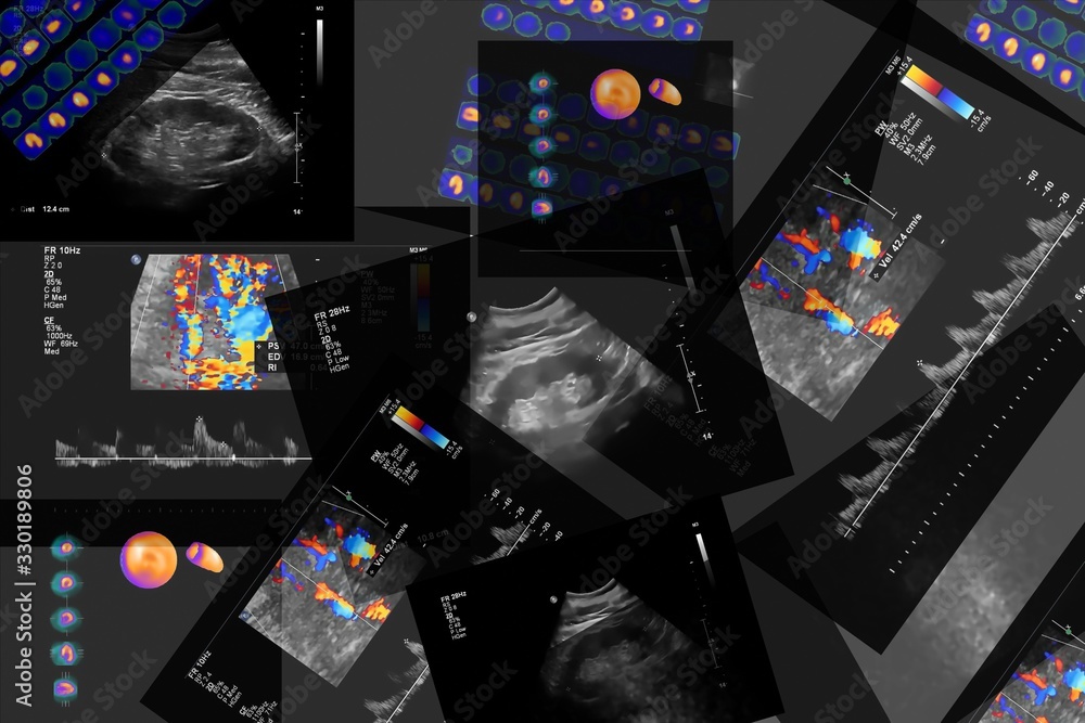 Coronary computed tomography angiography (CCTA) of the heart and ...
