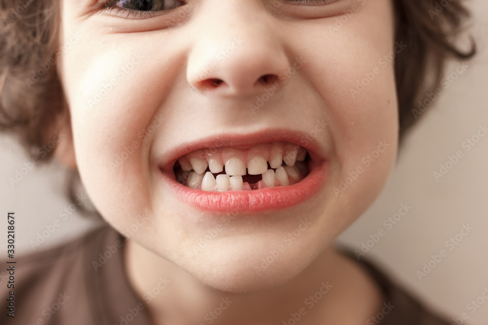 Charming curly boy smiles without tooth on white background. The boy ...