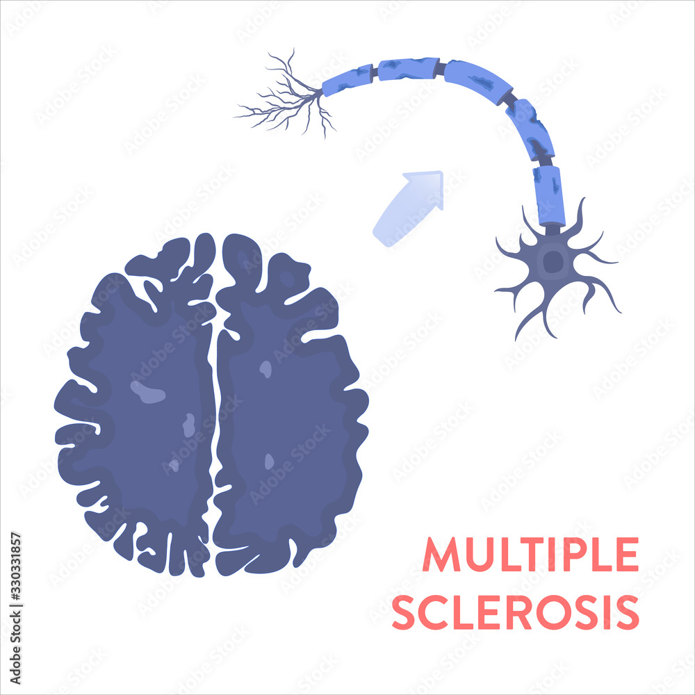Multiple sclerosis awareness illustration of an MRI scan of the brain ...