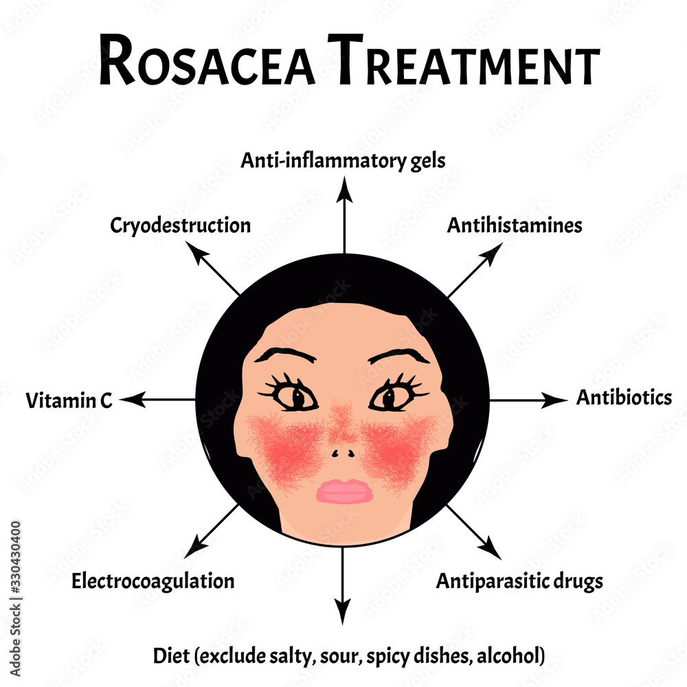 Rosacea treatment. Rosacea Awareness Month. Infographics. Vector ...
