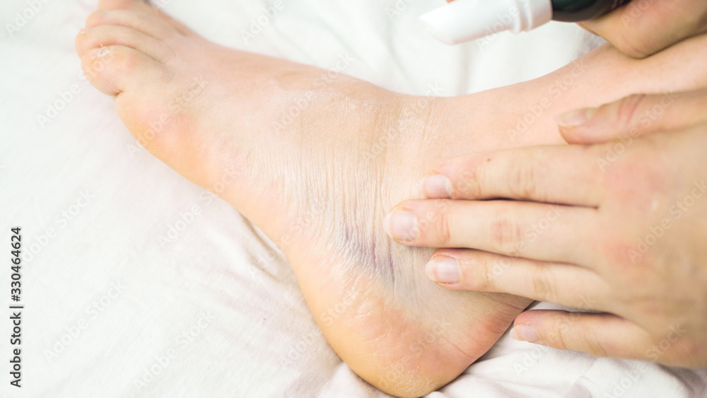 Woman is applying gel on her leg with sprained ankle isolated on white ...