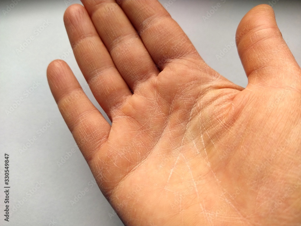 Female hand with dry atopic skin. White background. Close-up of the ...