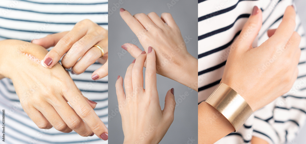 Before and after concept. A woman applying treatment cream to removal ...