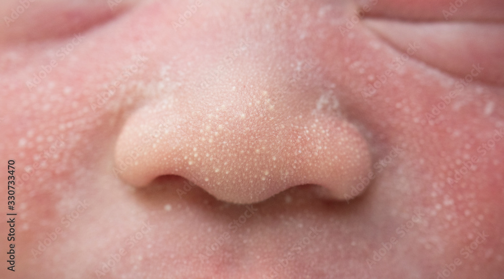 Macro, close-up shot of the milia on a two day old baby cheek, nose and ...