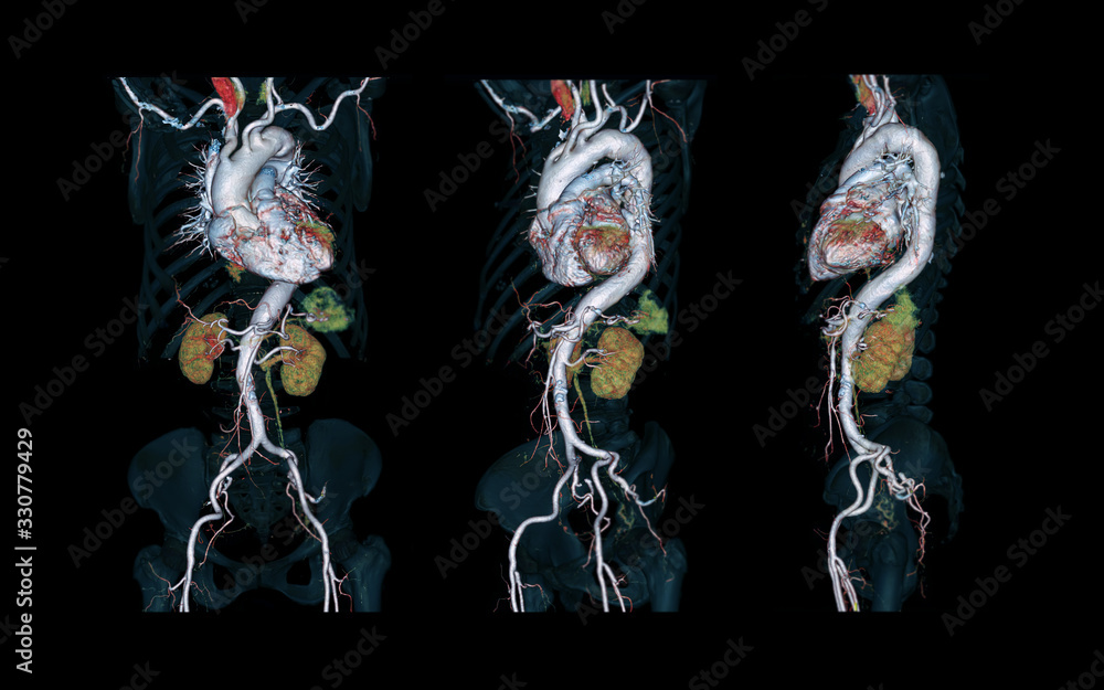 CTA Whole aorta 3D rendering image on black background for detect aortic aneurysm. Stock ...