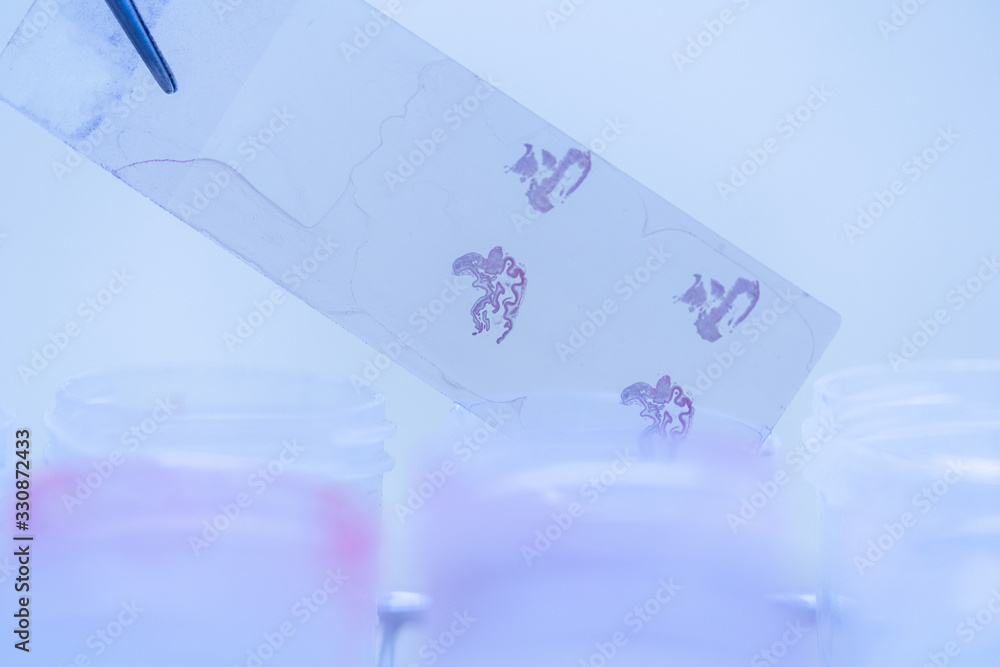 Scientist is preparing a tumor slide. Microscopy of cytopathology ...