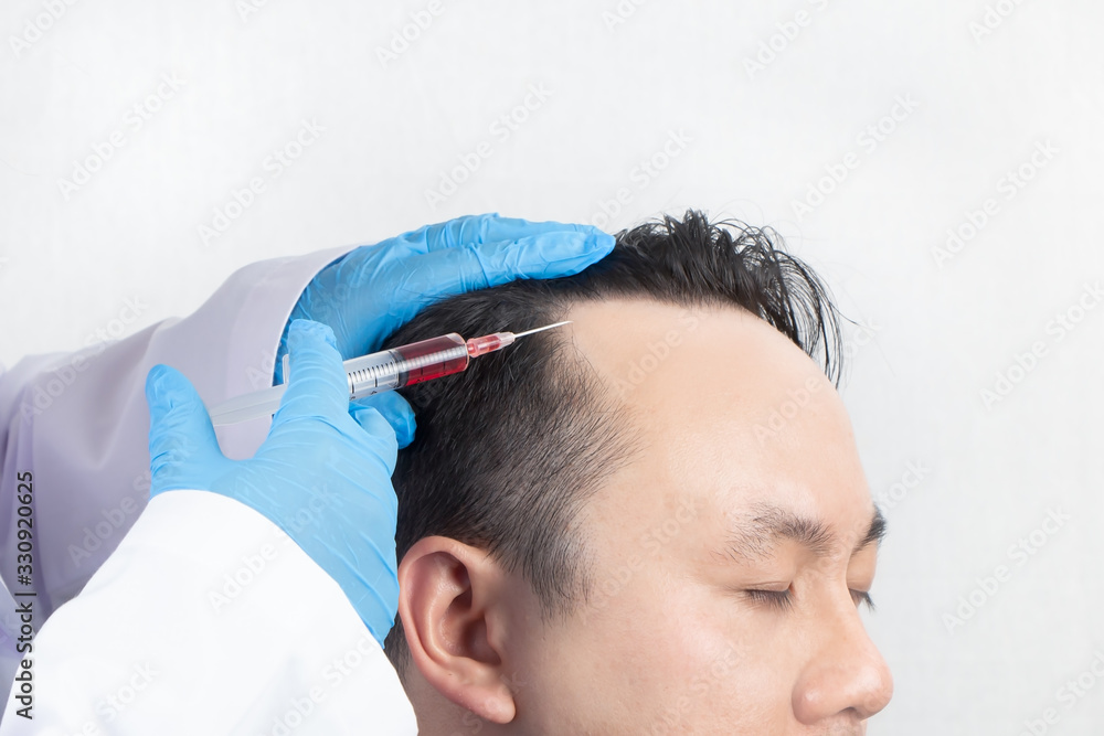 Close up of a bald man receiving injection in scalp from doctor. Man's ...