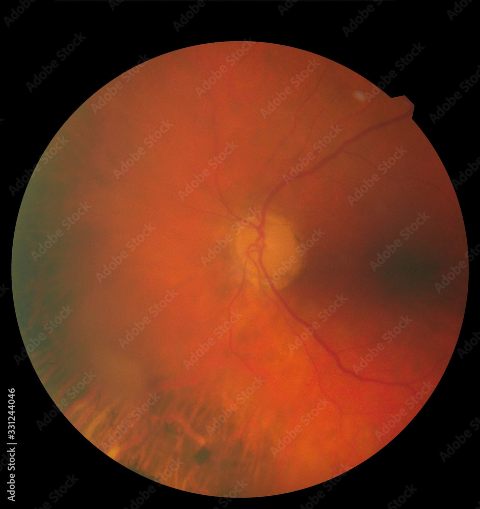 Ophthalmic image detailing the retina and optic nerve inside a healthy ...