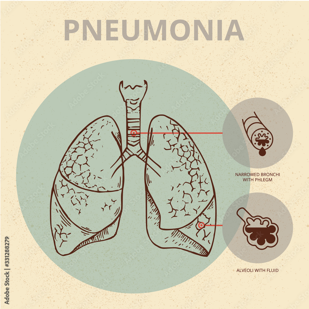 Pneumonia Lungs Diagram