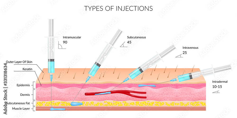 Poster Types of different injections on a white background with the ...