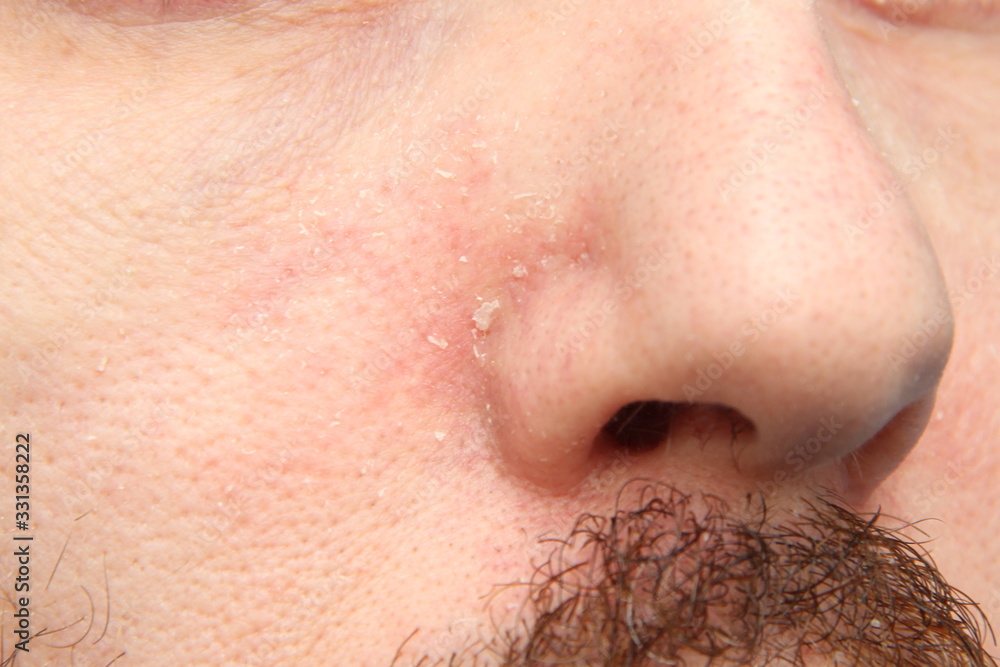 Part of the face with the nose of an adult white man with dry, flaky ...