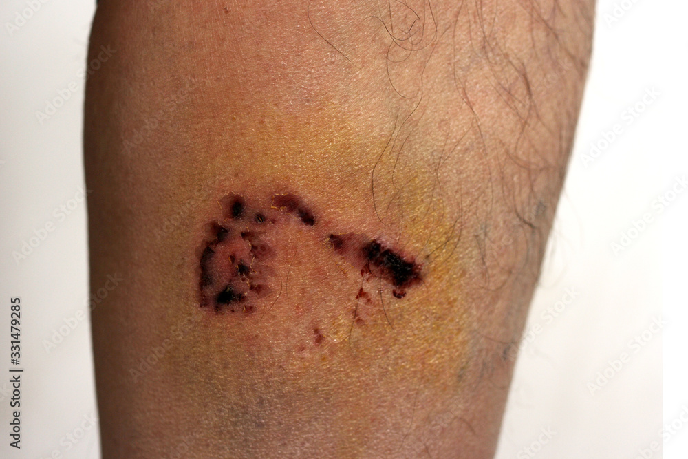 Dog bite on the foot. Sore foot from a dog bite Stock Photo | Adobe Stock